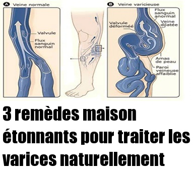 3 remèdes maison étonnants pour traiter les varices naturellement ...