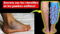 Œdème : Pieds enflés, chevilles enflées et jambes enflées [Remède ...