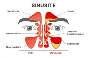 Comment soigner une sinusite naturellement ? - Santé Nutrition